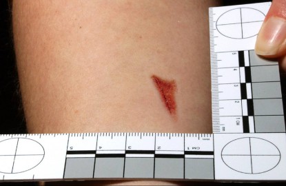 wound imaging :: www.forensicmed.co.uk