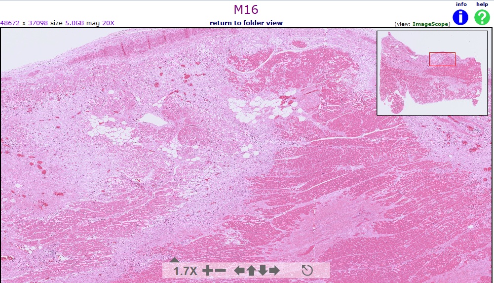 sudden cardiac death and coronary artery disease :: www.forensicmed.co.uk